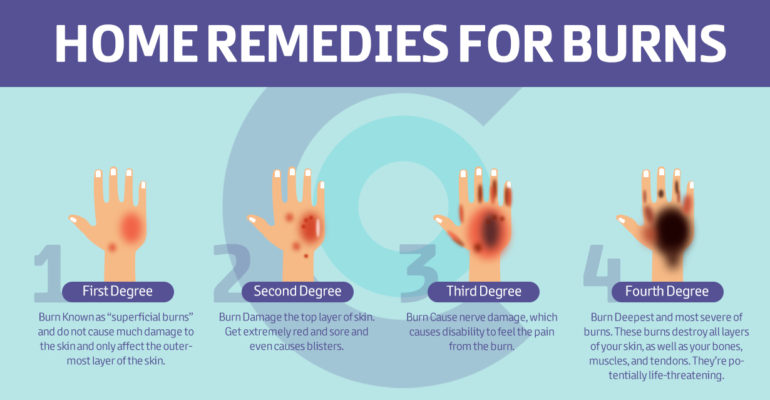Home Remedies for Burns - Conkote